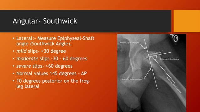 Slipped capital femoral epiphysis | PPT