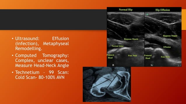 Slipped capital femoral epiphysis | PPT
