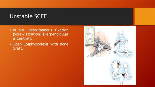 Slipped capital femoral epiphysis | PPT