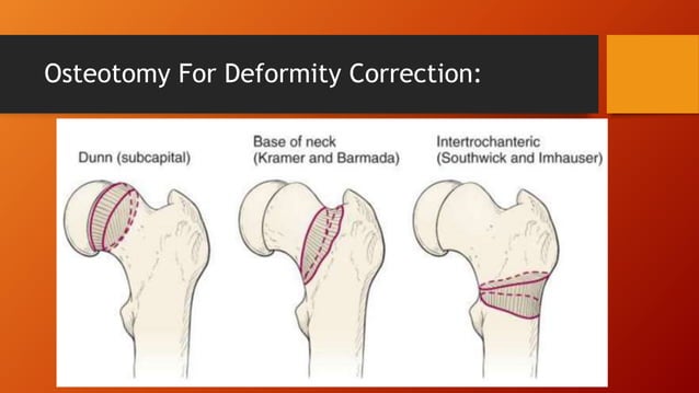 Slipped capital femoral epiphysis | PPT