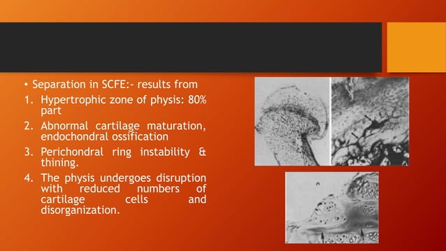 Slipped capital femoral epiphysis | PPT