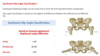 SCFE.pptx /slipped capital femoral epiphysis | PPT