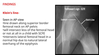 SCFE.pptx /slipped capital femoral epiphysis | PPT