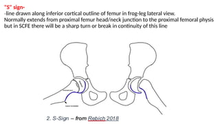 SCFE.pptx /slipped capital femoral epiphysis | PPT