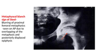 SCFE.pptx /slipped capital femoral epiphysis | PPT