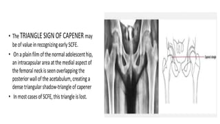 SCFE.pptx /slipped capital femoral epiphysis | PPT