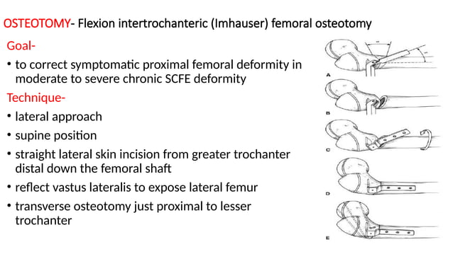 SCFE.pptx /slipped capital femoral epiphysis | PPT
