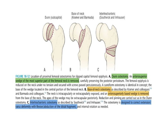 Slipped capital femoral epiphysis-Paediatric orthopaedics | PPT