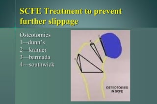 SLIPPED CAPITAL FEMORAL EPIPHYSIS - By Dr. Lokesh Sharoff | PPT