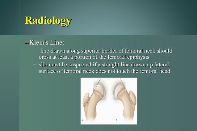 SLIPPED CAPITAL FEMORAL EPIPHYSIS - By Dr. Lokesh Sharoff