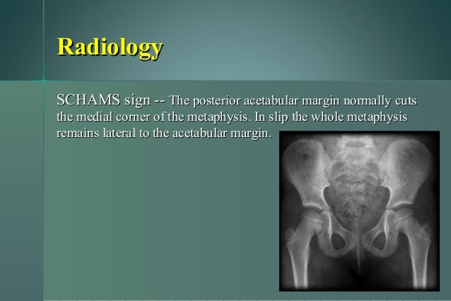 SLIPPED CAPITAL FEMORAL EPIPHYSIS - By Dr. Lokesh Sharoff