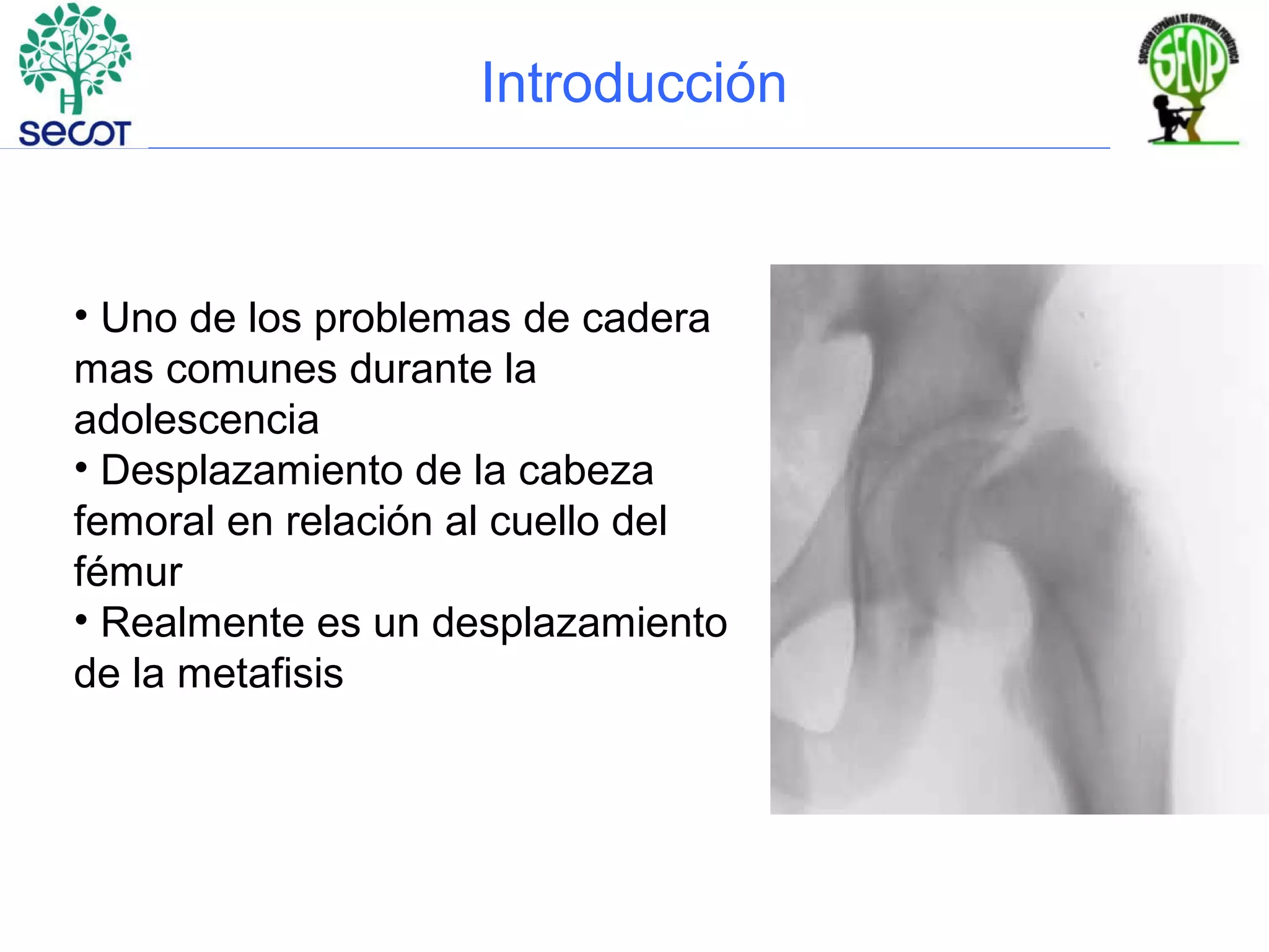 Epifisiolisis Capital Femoral (SCFE) | PPT | Bone and Joint Conditions ...