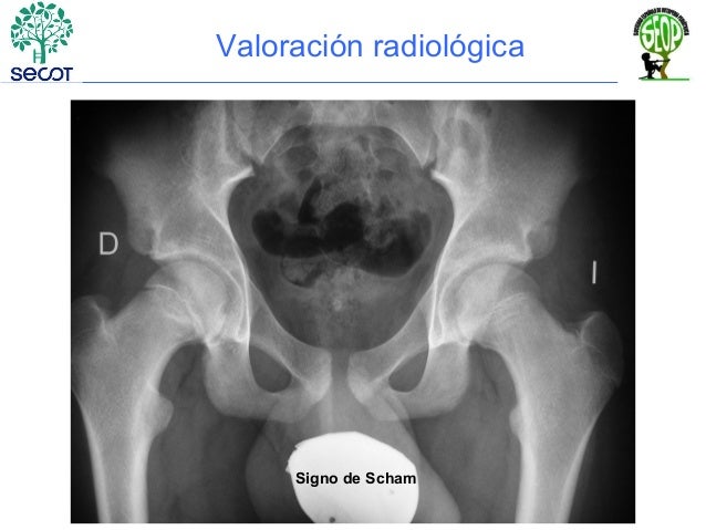 Epifisiolisis Capital Femoral (SCFE)