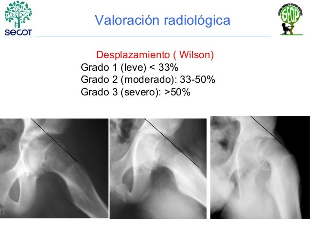 Epifisiolisis Capital Femoral (SCFE)