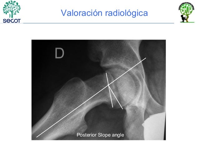 Epifisiolisis Capital Femoral (SCFE)