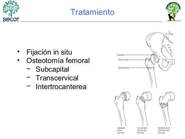 Epifisiolisis Capital Femoral (SCFE)