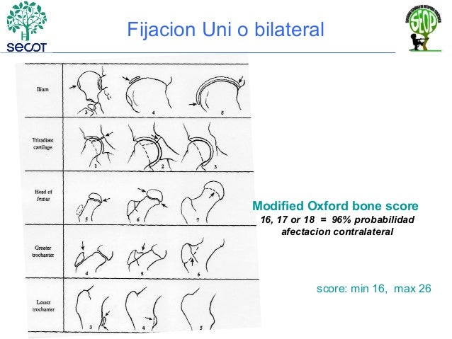 Epifisiolisis Capital Femoral (SCFE)