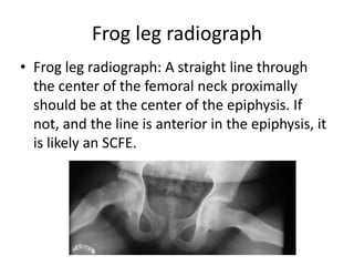 Slipped Capital Femoral Epiphysis | PPT