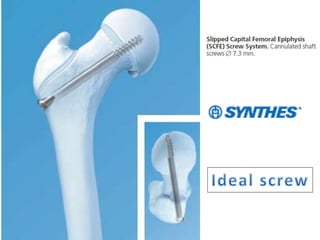 Slipped Capital Femoral Epiphysis | PPT