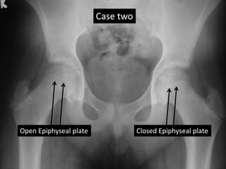 Slipped Capital Femoral Epiphysis | PPT