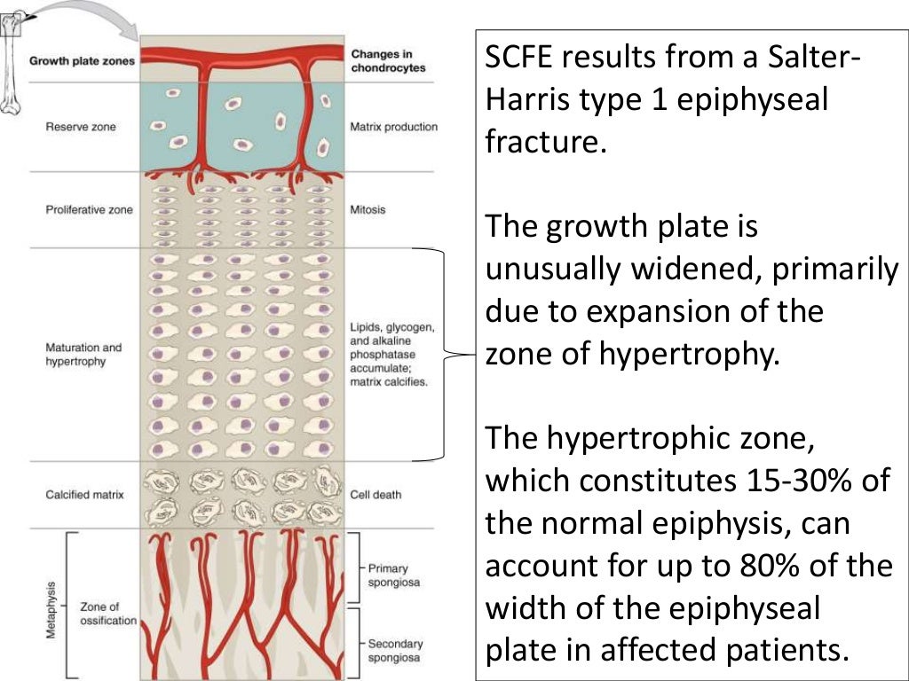 Slipped Capital Femoral Epiphysis