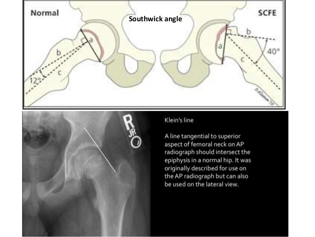 Slipped Capital Femoral Epiphysis