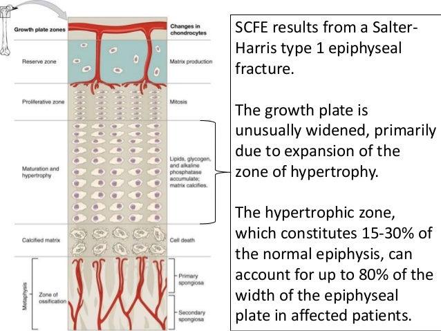 Slipped Capital Femoral Epiphysis