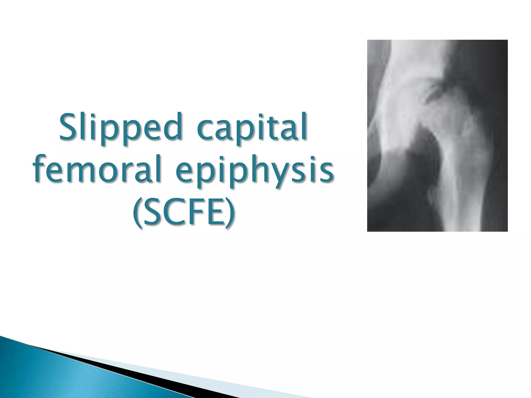 Slipped capital femoral epiphysis vamshi kiran feb 6/2013 | PPTX