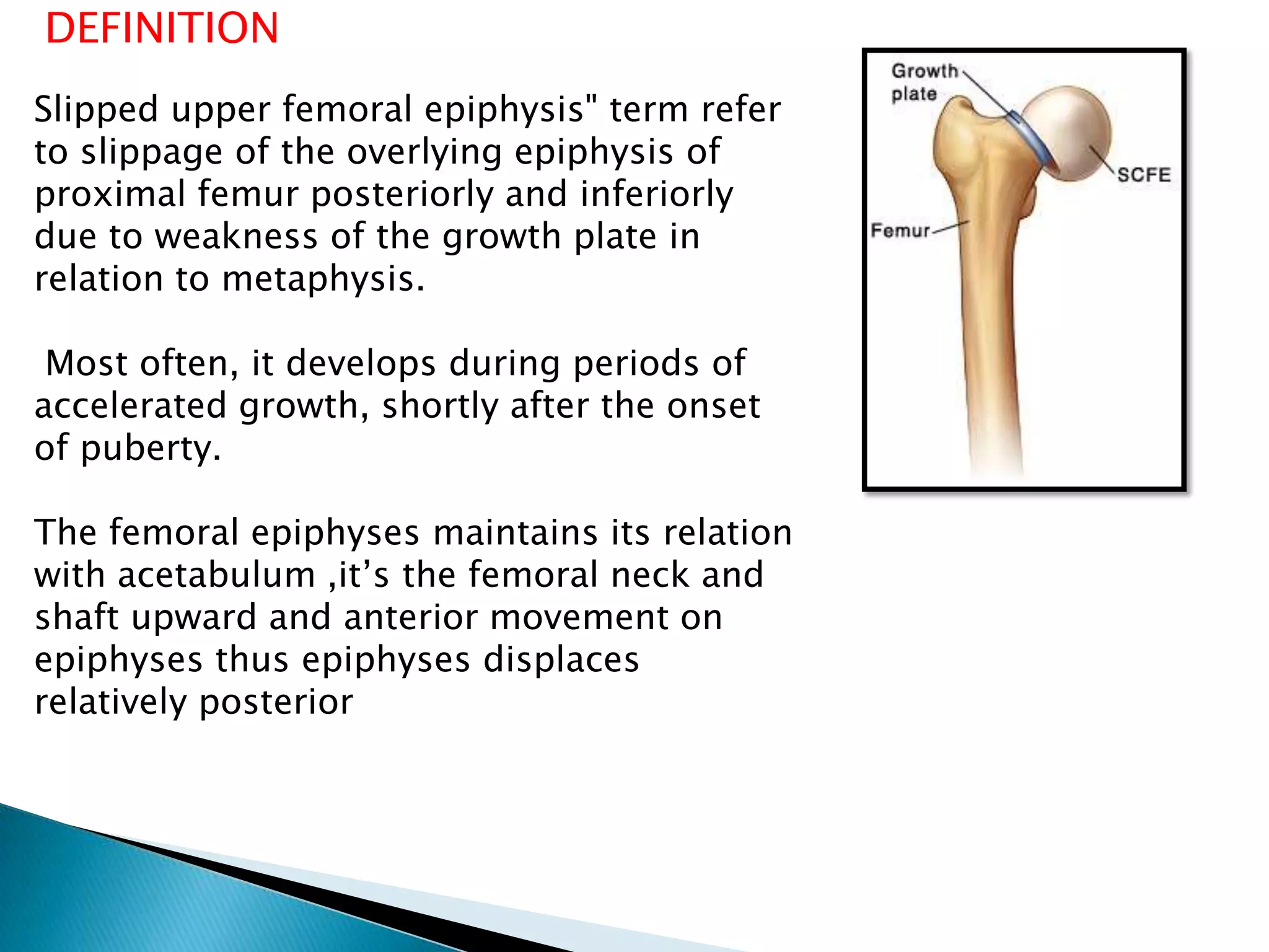 Slipped capital femoral epiphysis vamshi kiran feb 6/2013 | PPTX