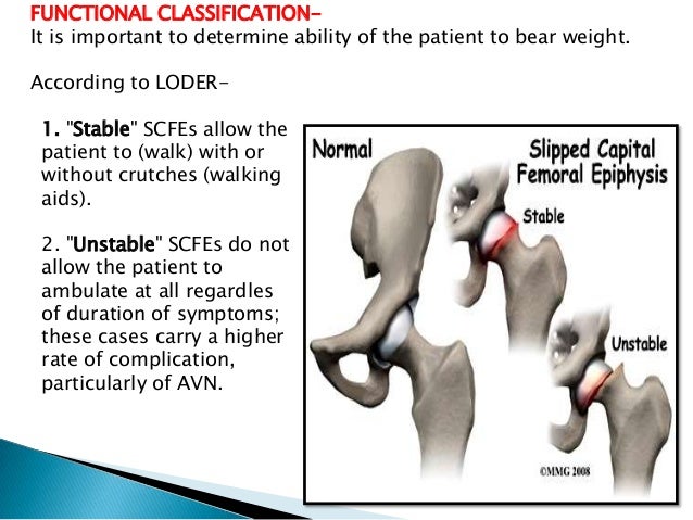 Slipped capital femoral epiphysis vamshi kiran feb 6/2013