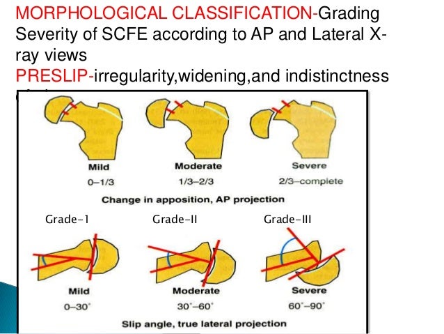 Slipped capital femoral epiphysis vamshi kiran feb 6/2013