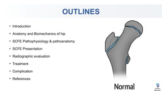 Slipped Capital Femoral Epiphysis (SCFE) DR NKUNDIMANA JEAN PAUL.pptx