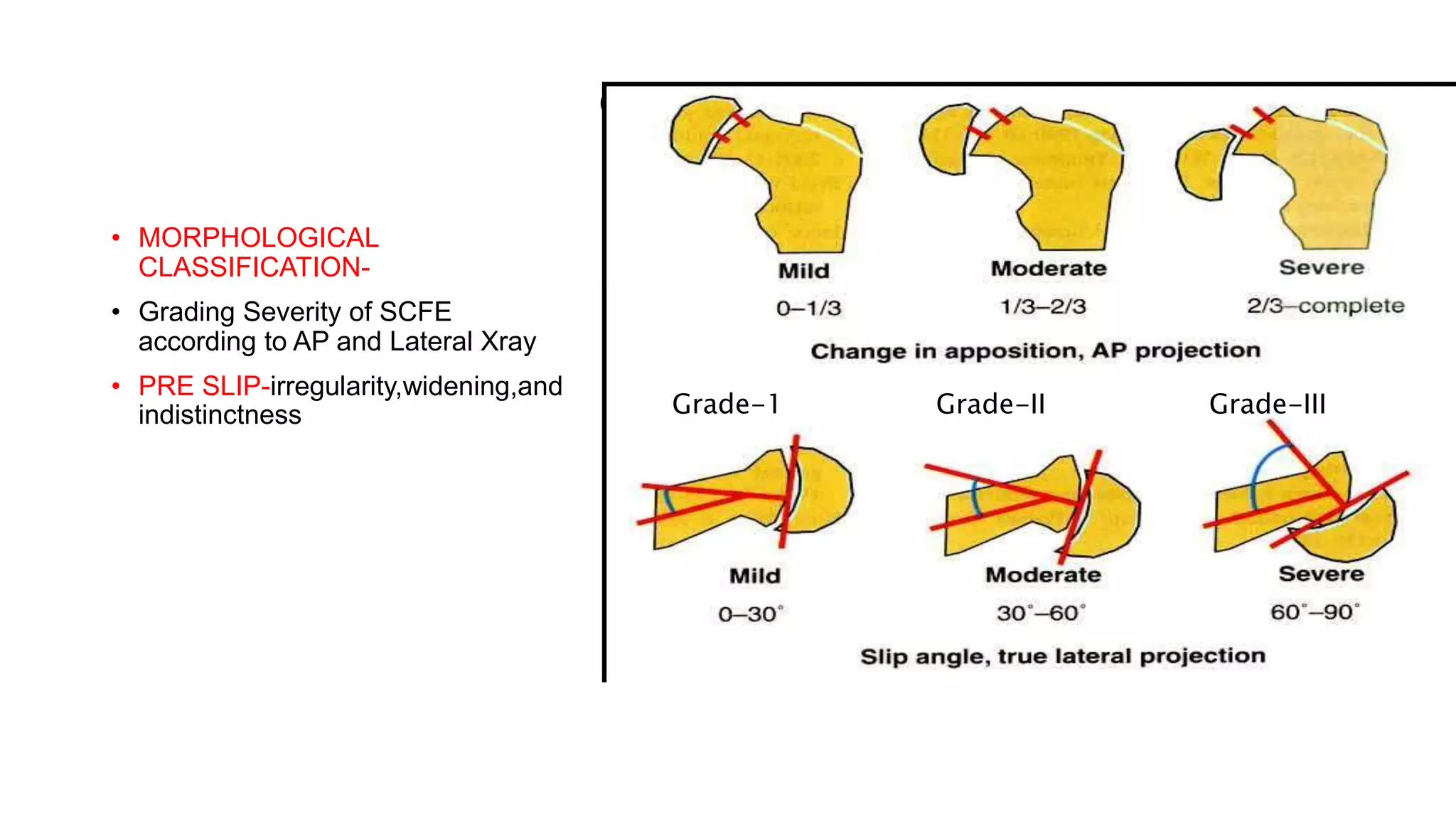 SCFE / slipped capital femoral epiphysis | PPTX