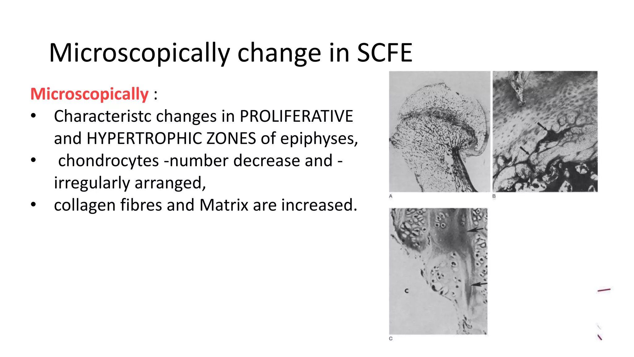 SCFE / slipped capital femoral epiphysis | PPTX