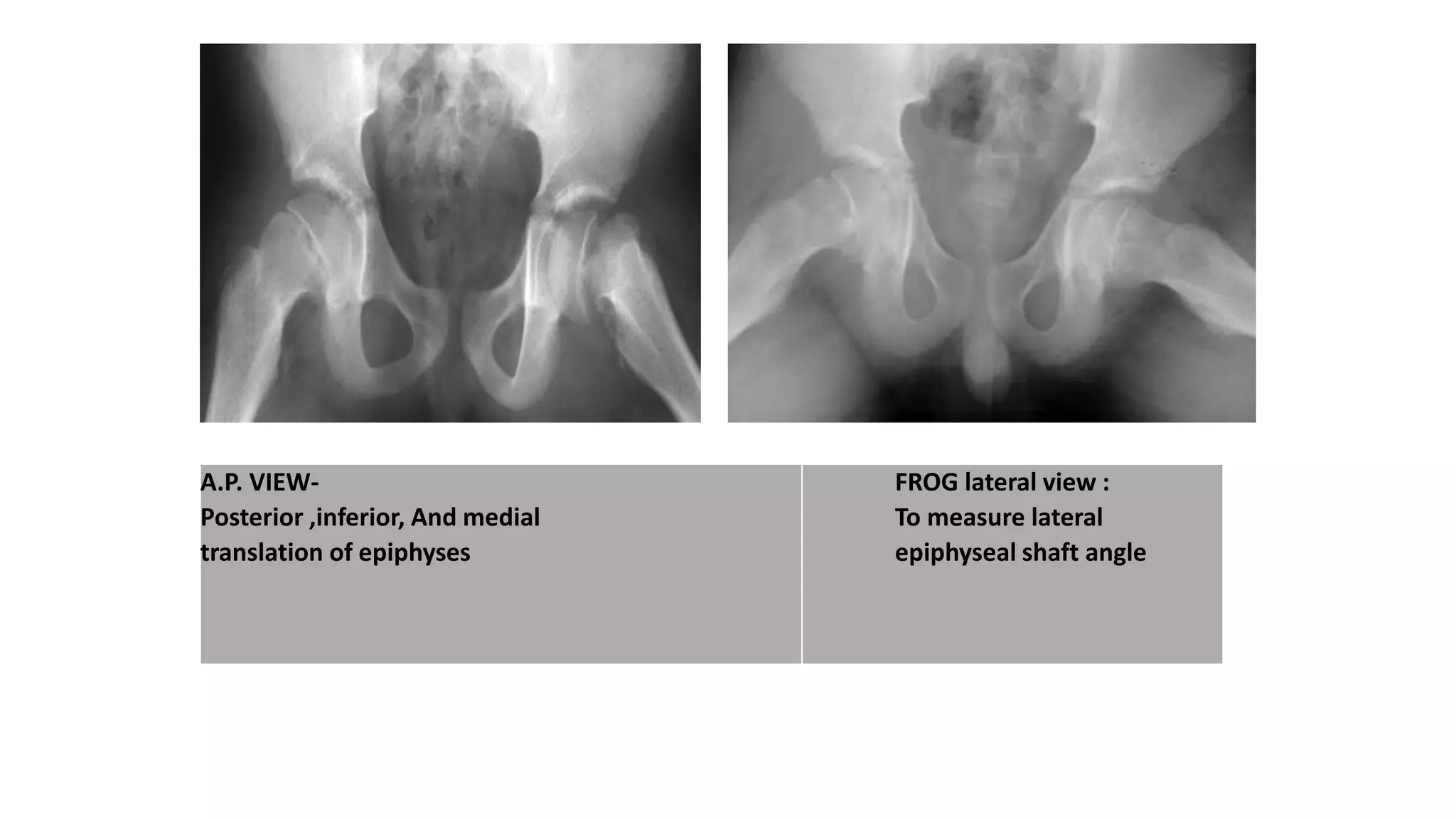 SCFE / slipped capital femoral epiphysis | PPTX