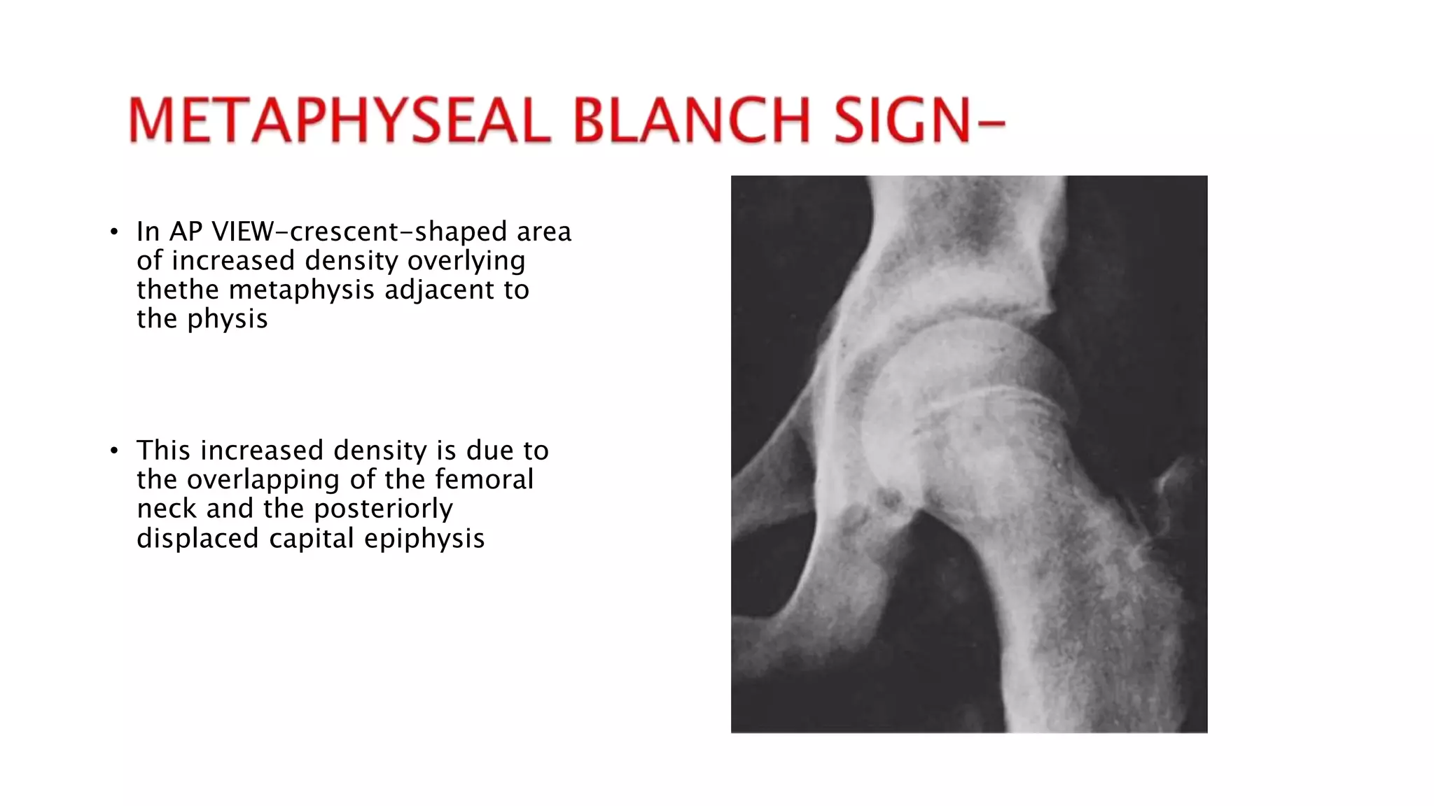 SCFE / slipped capital femoral epiphysis | PPTX