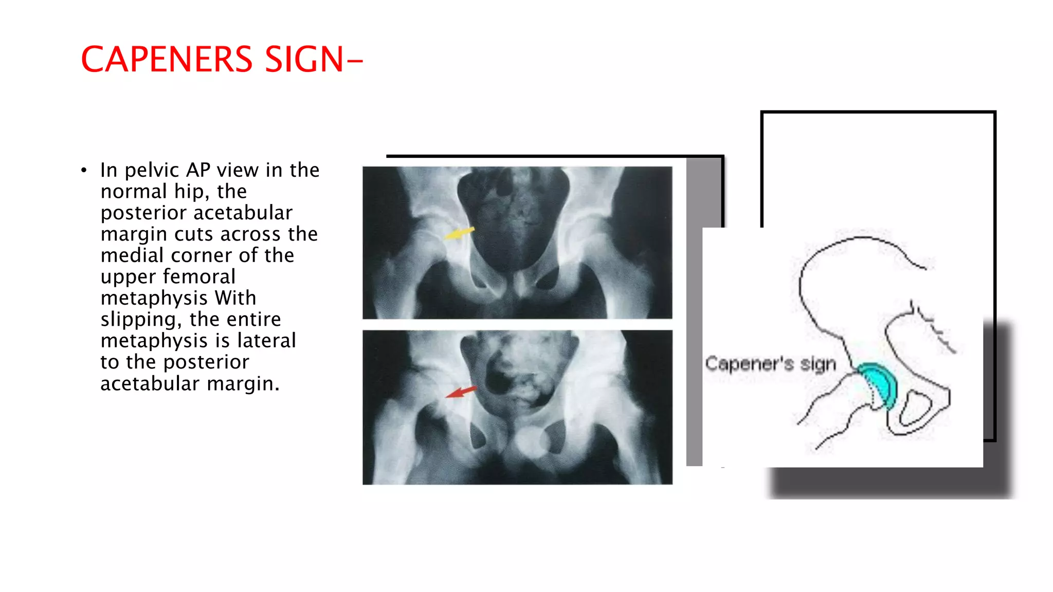 SCFE / slipped capital femoral epiphysis | PPTX