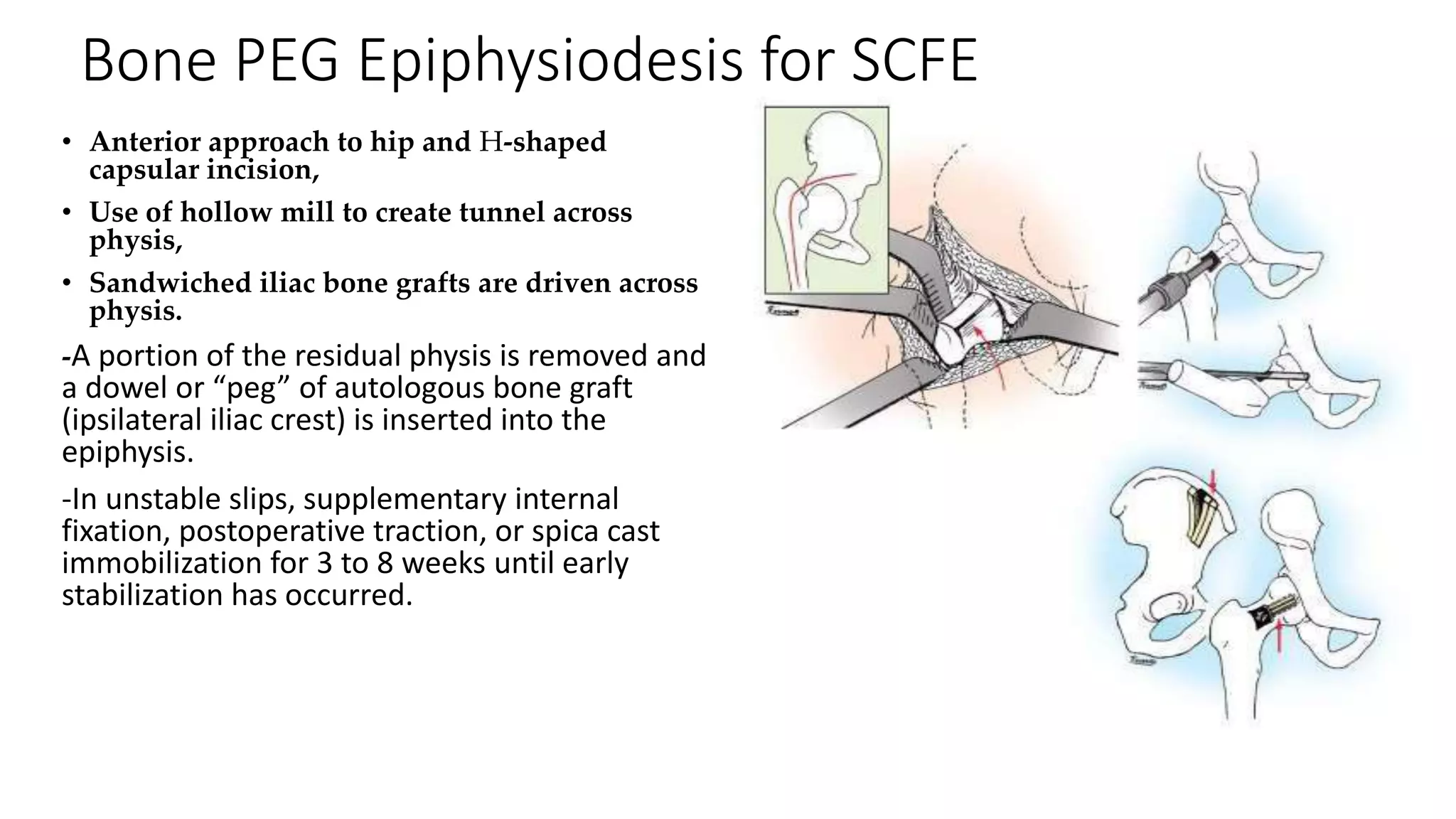 SCFE / slipped capital femoral epiphysis | PPTX