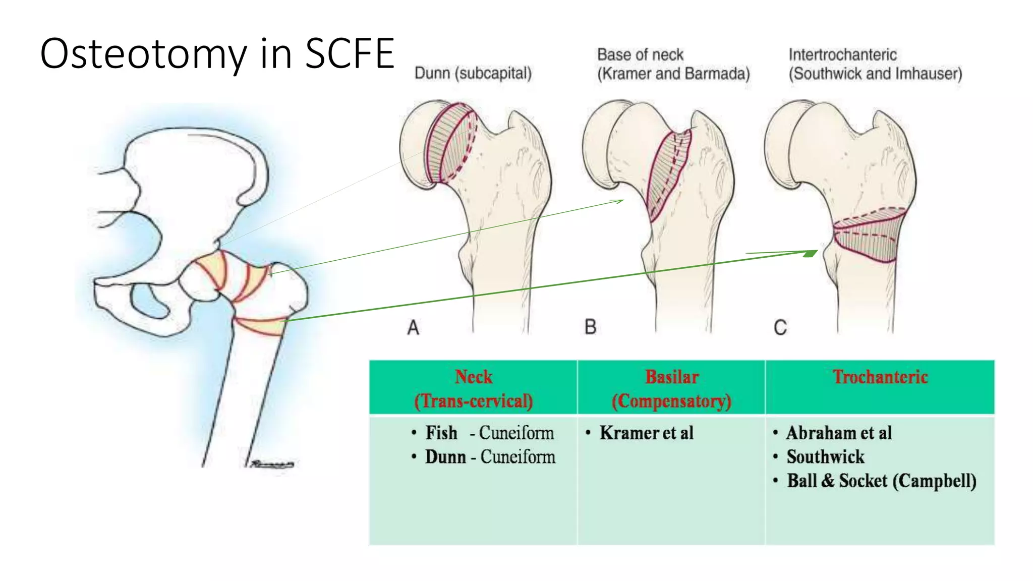 SCFE / slipped capital femoral epiphysis | PPTX