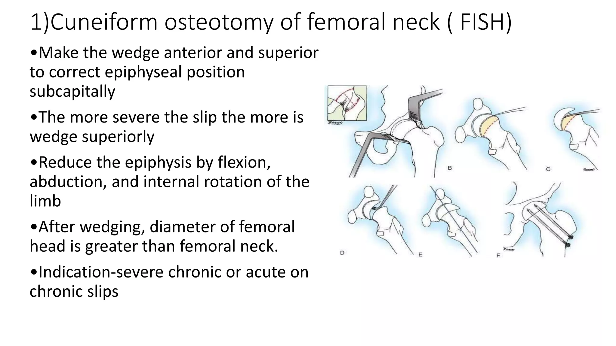 SCFE / slipped capital femoral epiphysis | PPTX