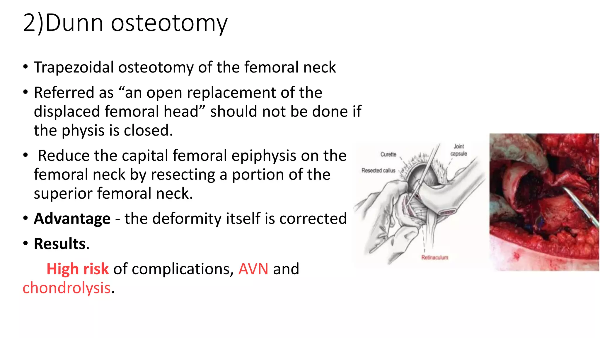 SCFE / slipped capital femoral epiphysis | PPTX