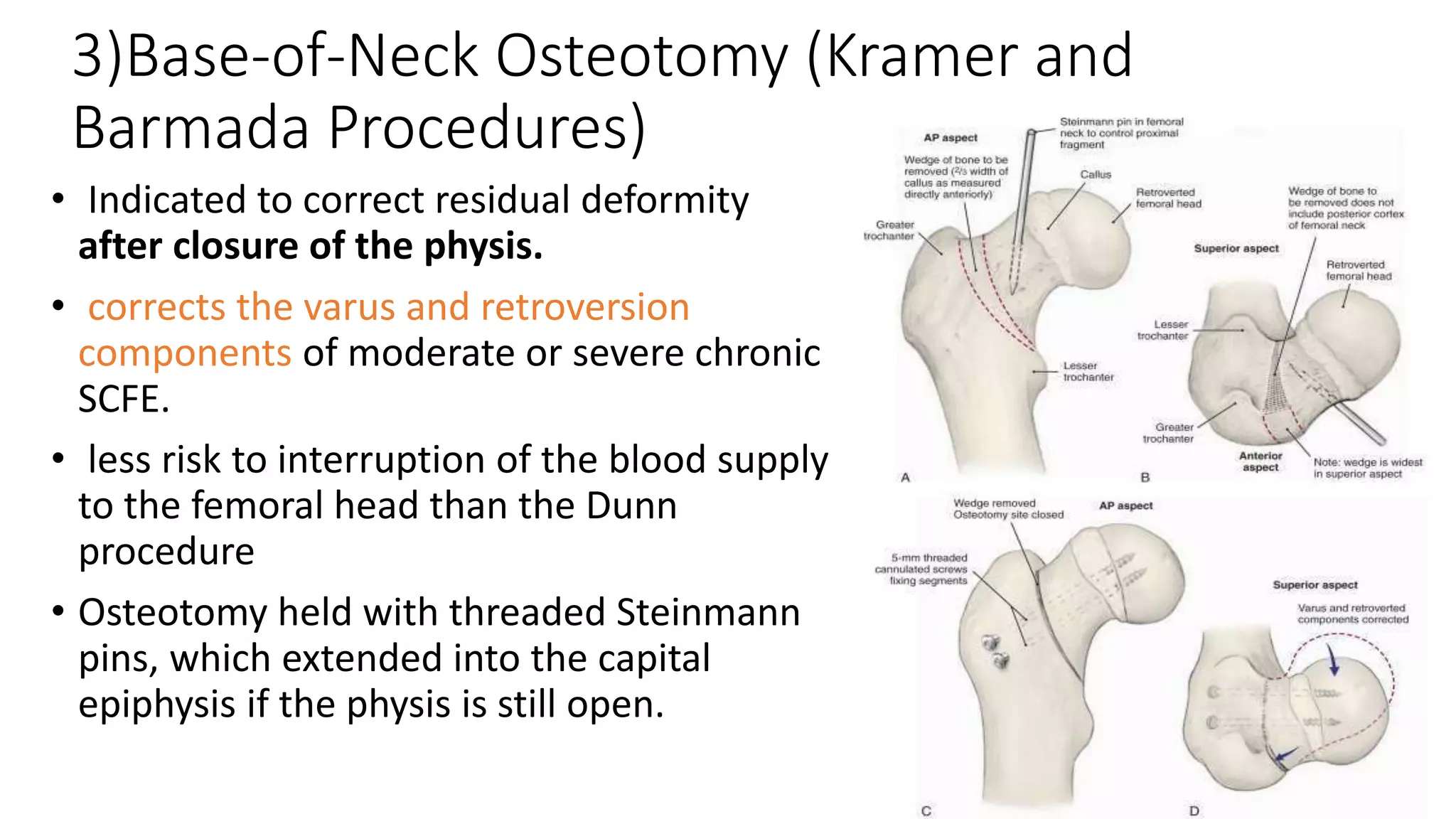 SCFE / slipped capital femoral epiphysis | PPTX