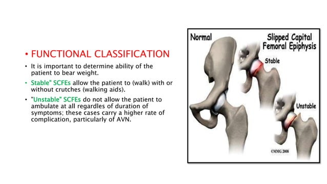 SCFE / slipped capital femoral epiphysis | PPTX | Bone and Joint ...
