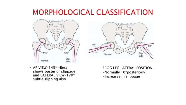 SCFE / slipped capital femoral epiphysis | PPTX | Bone and Joint ...