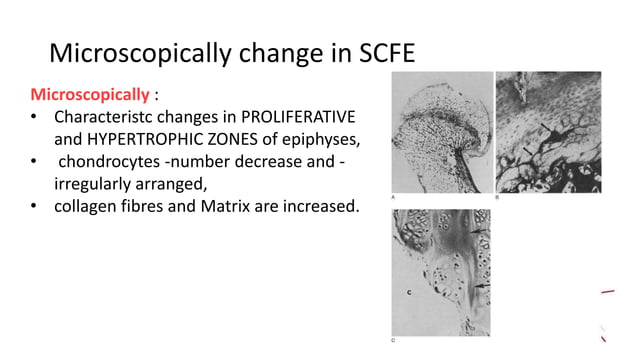 SCFE / slipped capital femoral epiphysis | PPTX | Bone and Joint ...