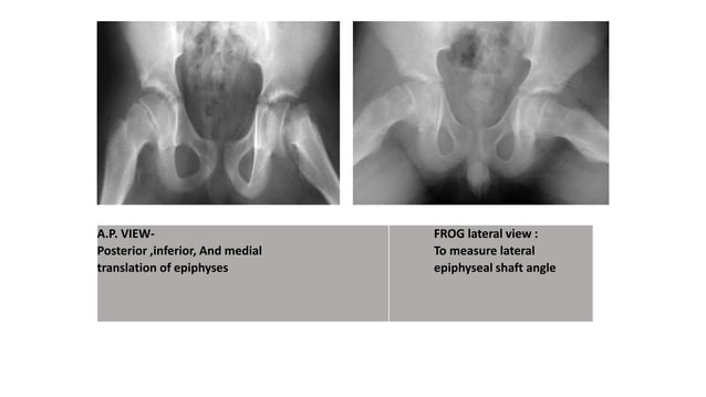 SCFE / slipped capital femoral epiphysis | PPTX | Bone and Joint ...