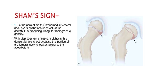 SCFE / slipped capital femoral epiphysis | PPTX | Bone and Joint ...