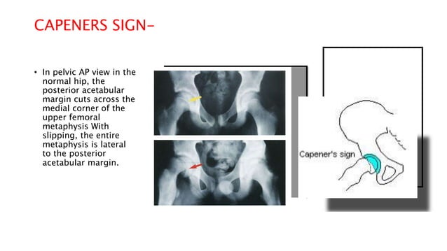 SCFE / slipped capital femoral epiphysis | PPTX | Bone and Joint ...