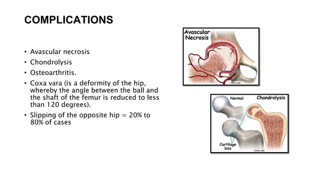SCFE / slipped capital femoral epiphysis | PPTX | Bone and Joint ...