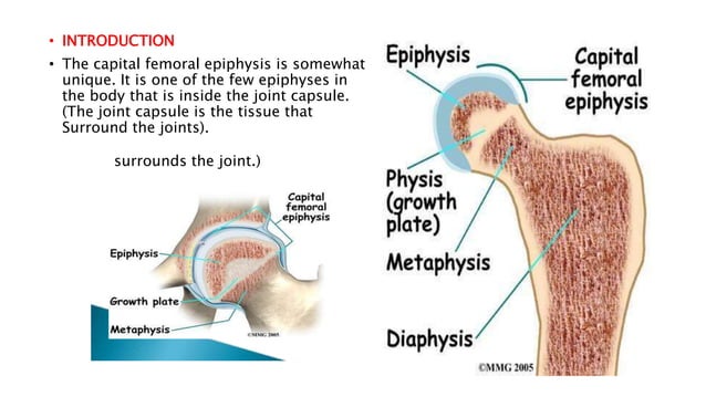 SCFE / slipped capital femoral epiphysis | PPTX | Bone and Joint ...